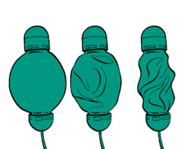 Pumpe med pip/taz (elastomerisk pumpe) - Sundhed - Region Midtjylland